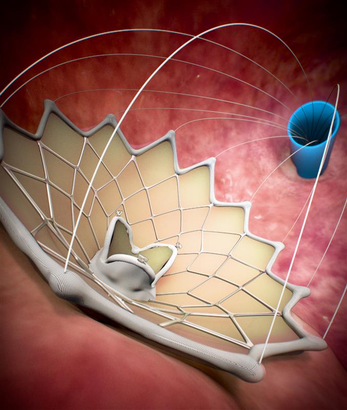 Cardiology Medical Animation | Ghost Medical