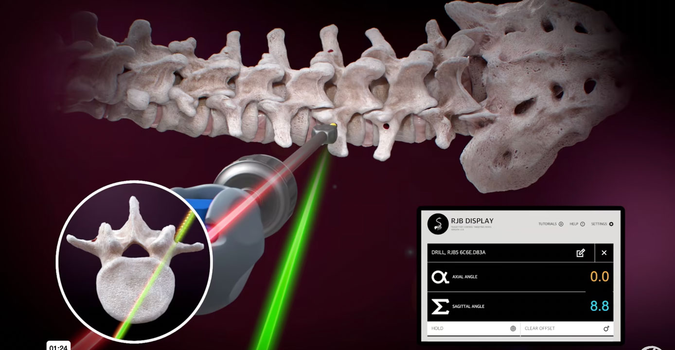 Orthopedic, Sports Medicine, Joint & Trauma animation | Ghost Medical