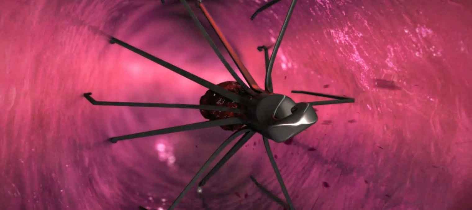 "Using Inferior Vena Cava Filters to Prevent Pulmonary Embolism"