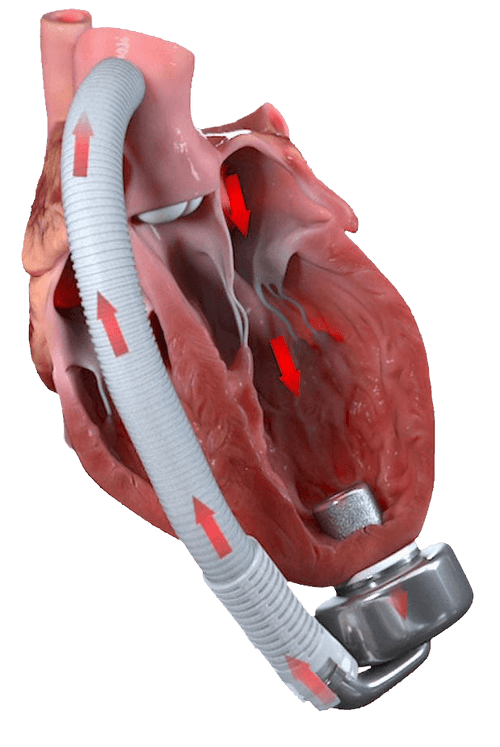 Cardiology Medical Animation | Ghost Medical