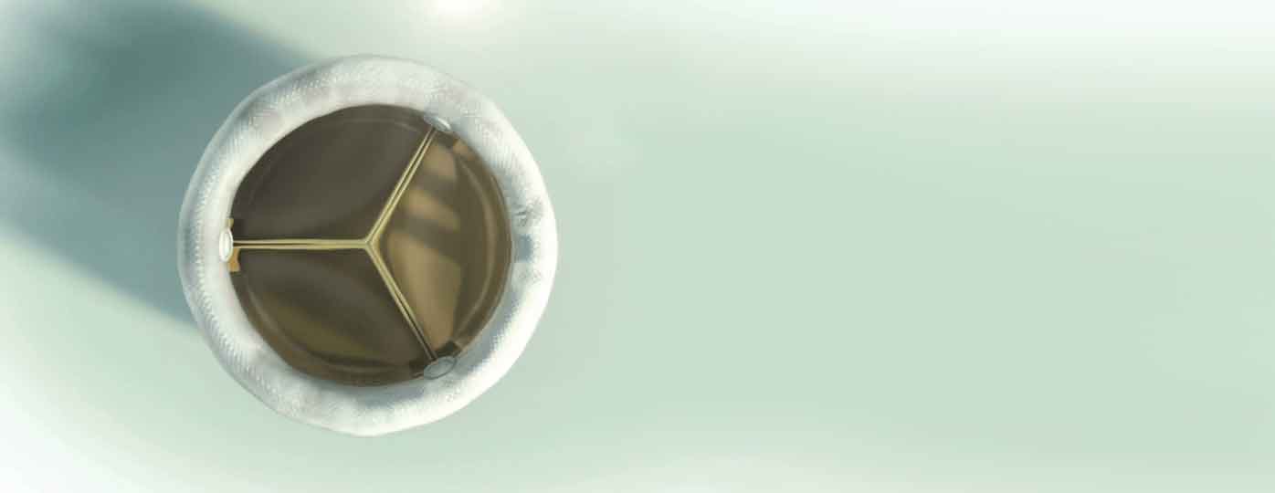 "TAVR Animation Case Study: DirectFlow Aortic Valve Implant"