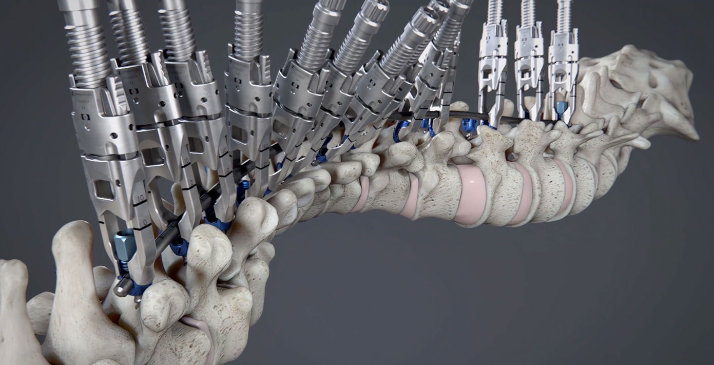 "Medical Animations for Spine Surgery"