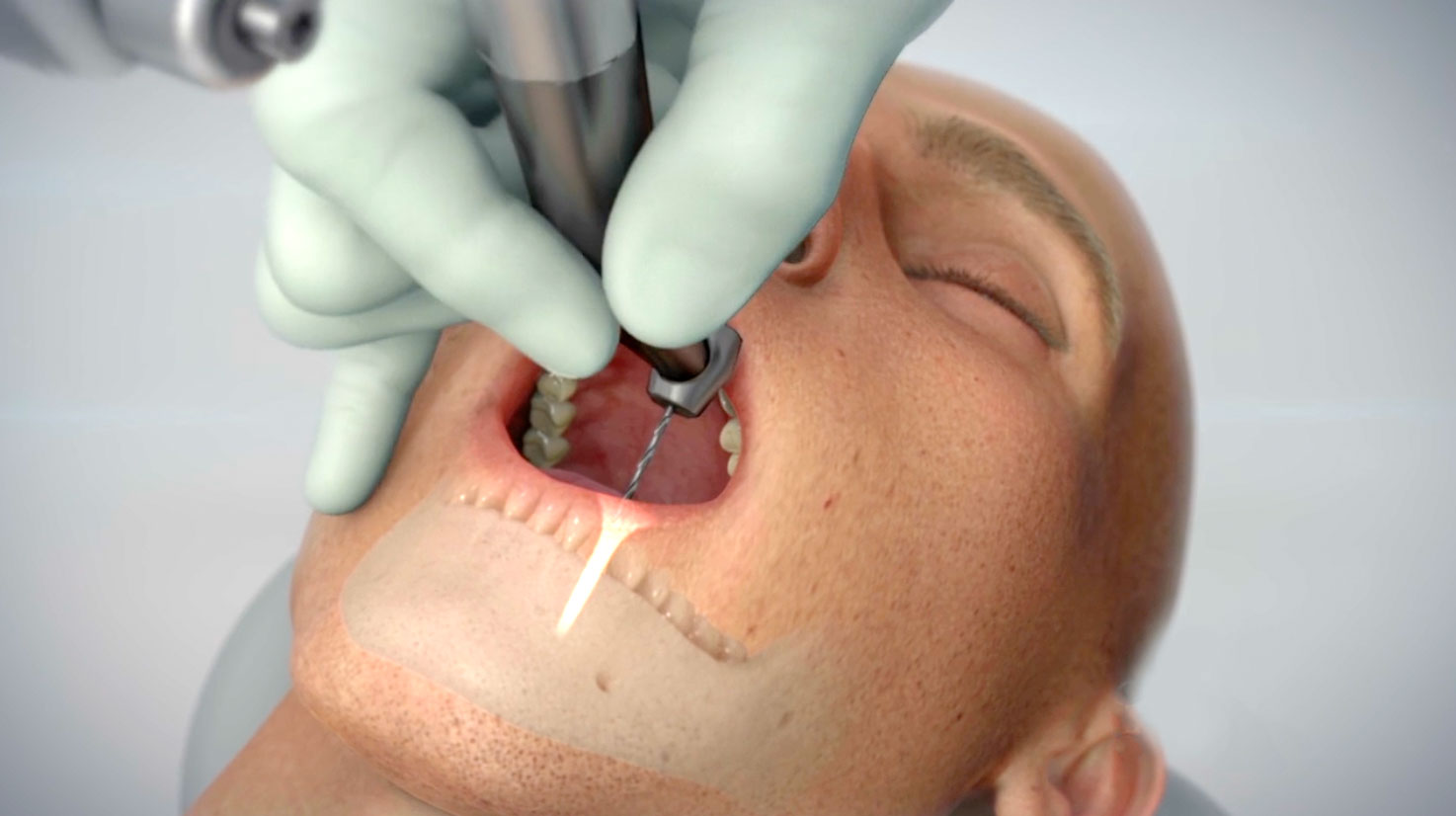 Dental Animation | Ghost Medical