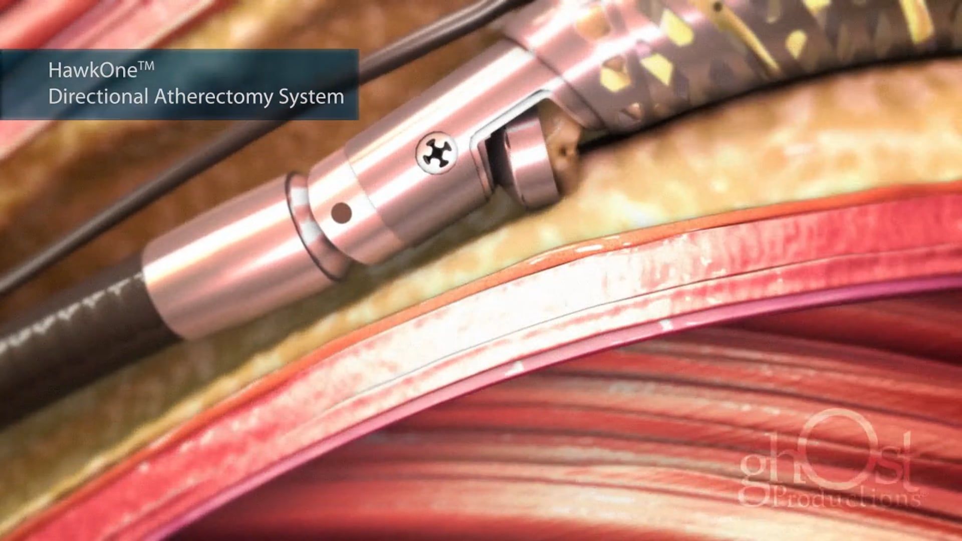 Ghost Productions - Medtronic - HawkOne | Video