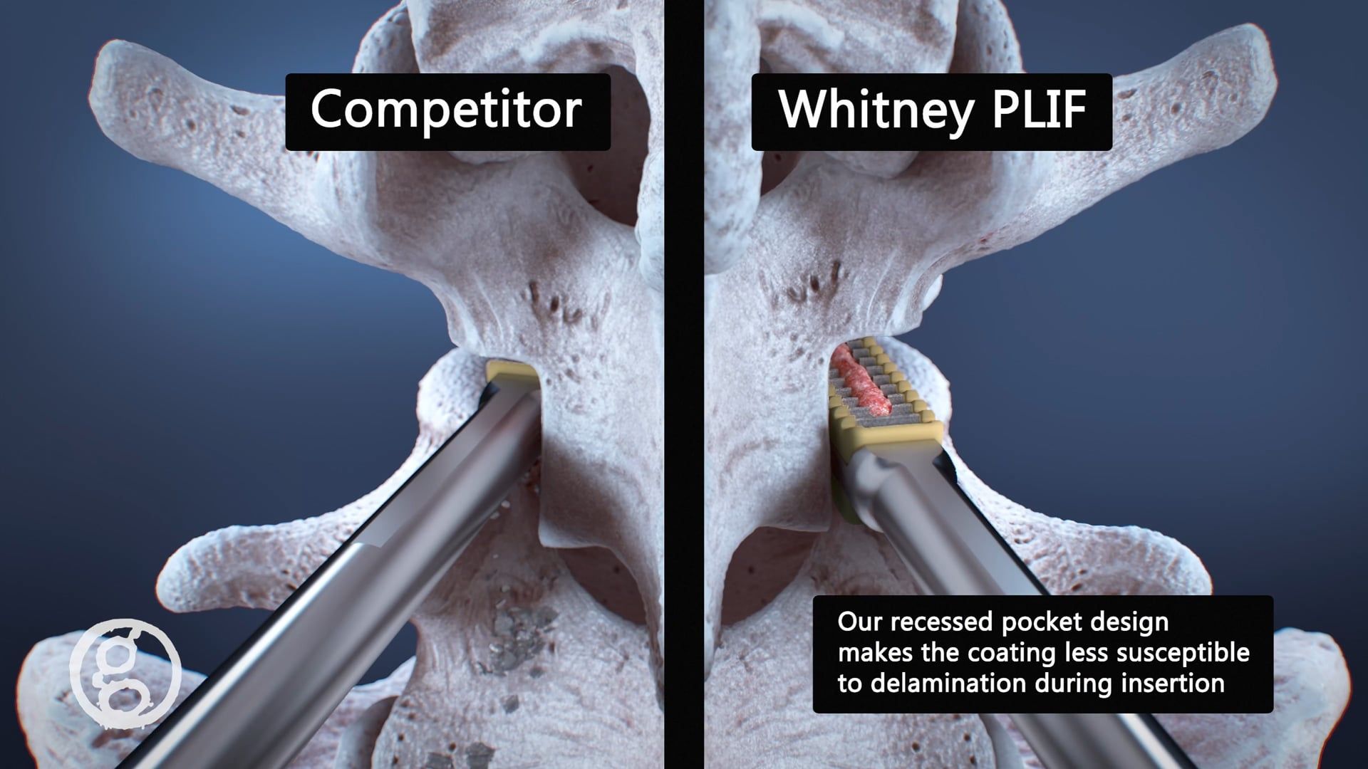 Medical Device Marketing - Zavation Whitney PLIF | Video