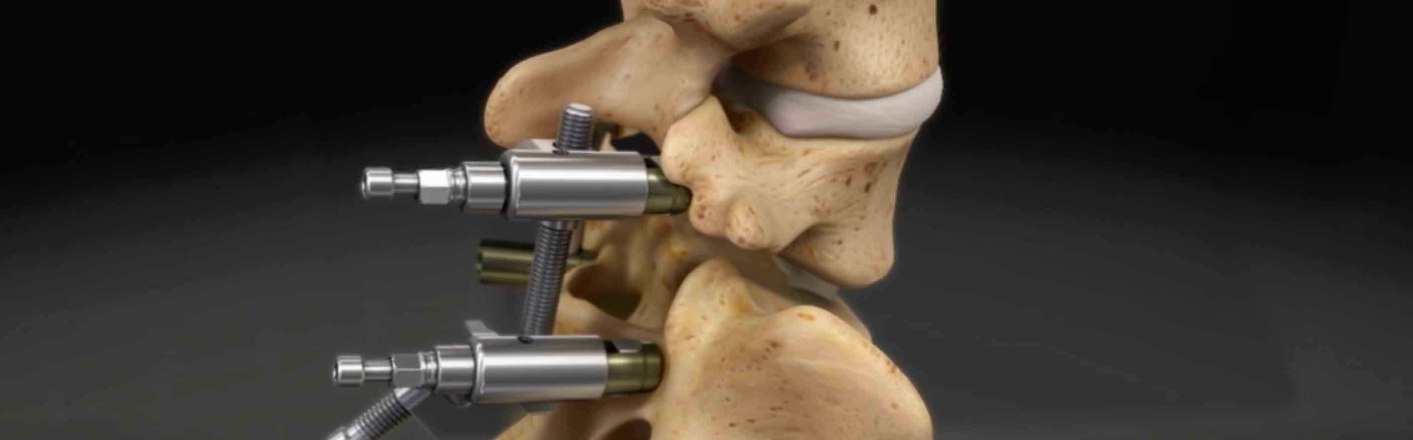 "Medical Animation Case Study: Aesculap – S4 SRI"