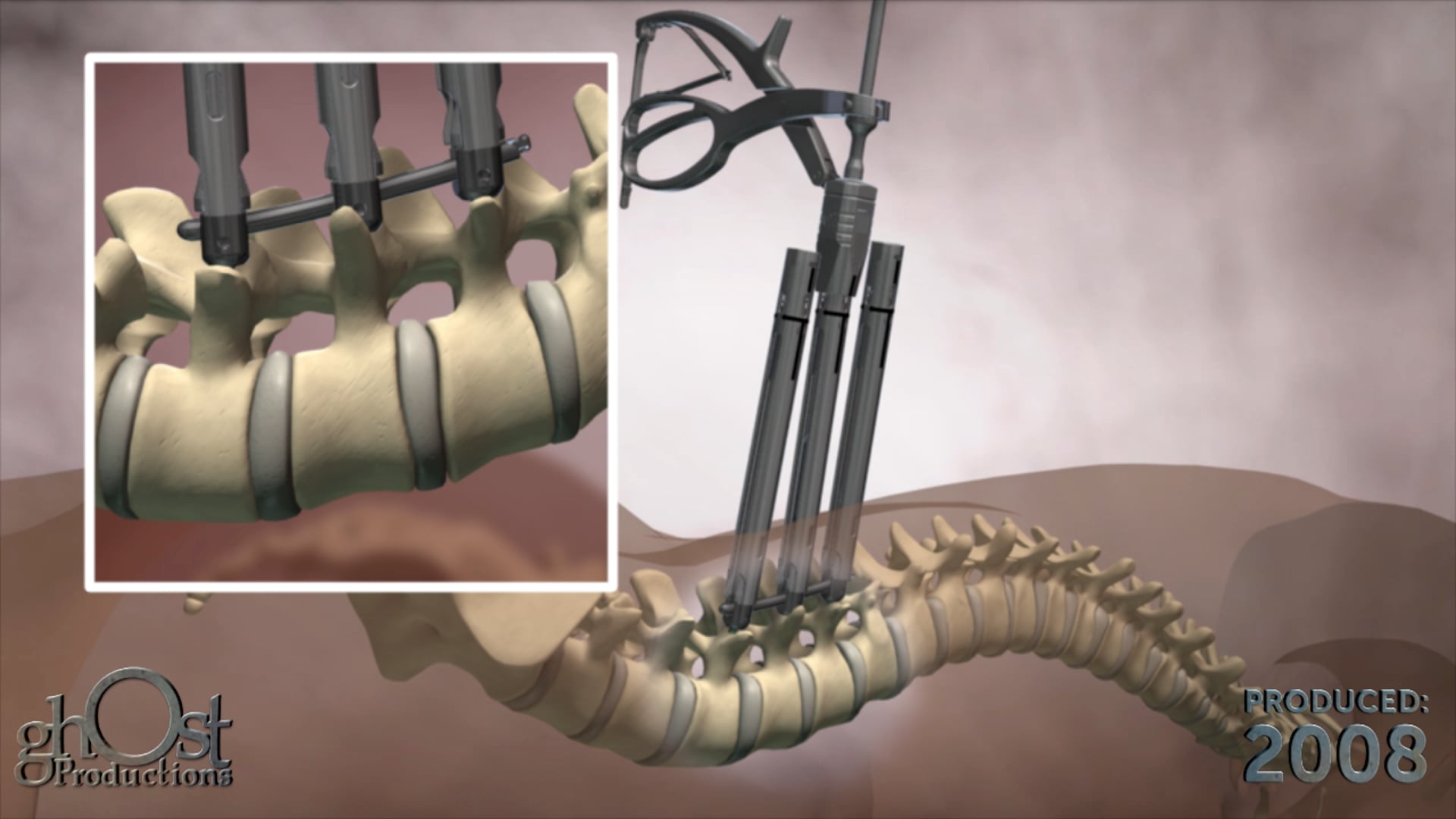 Depuy Viper2PistolGrip | Video