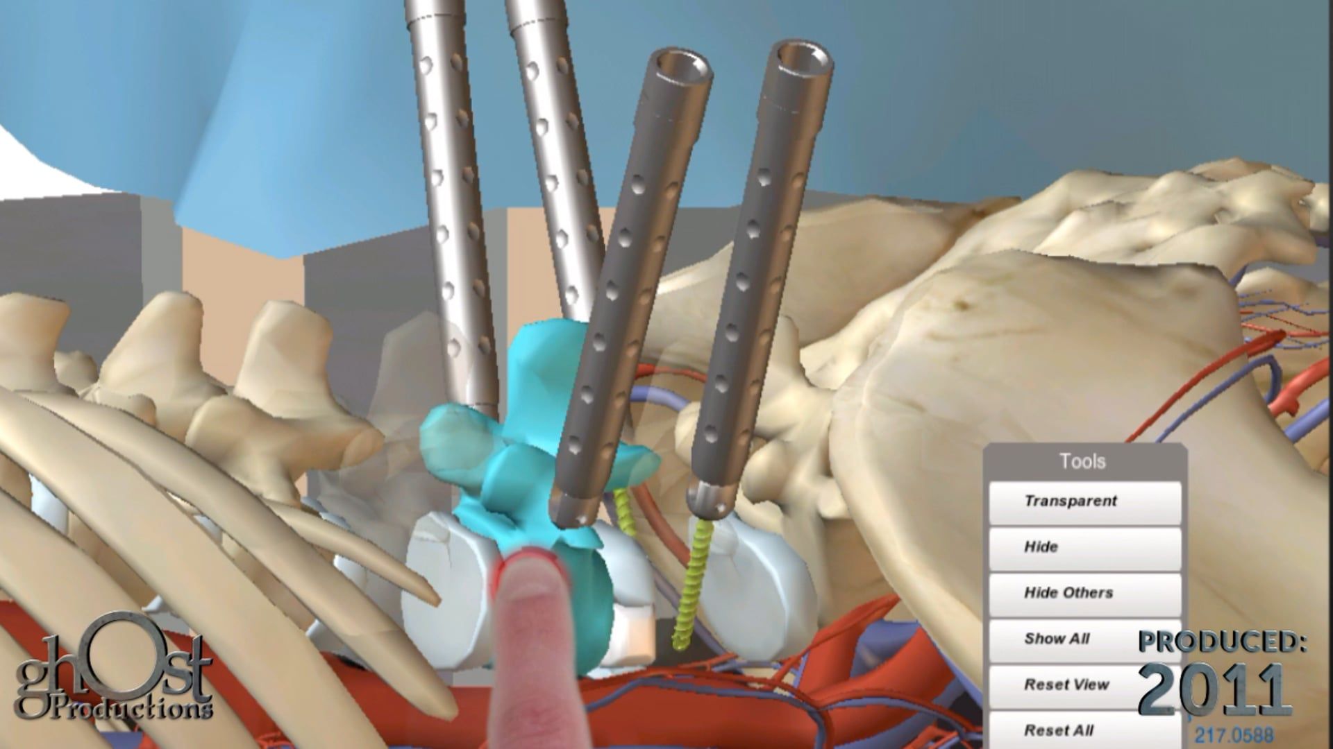 Depuy Spine App | Video