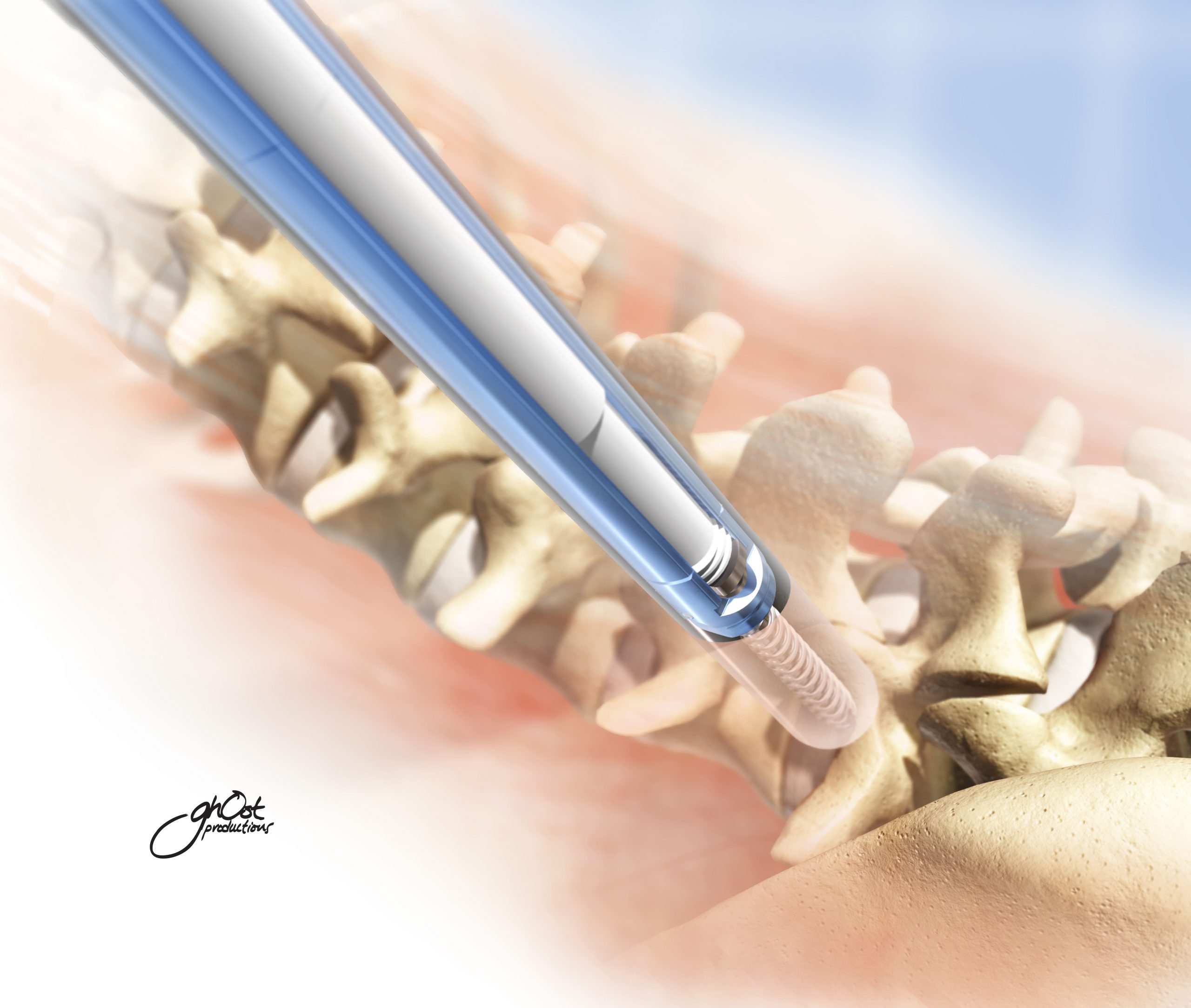 "Posterior Spinal Fixation Animation Case Study: FacetLink, Inc."