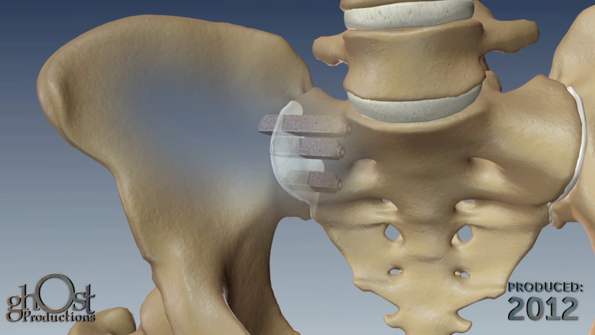 SI-BONE Procedure | Video