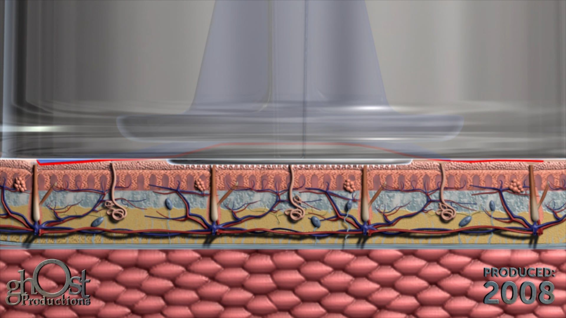 MTS Injection | Video