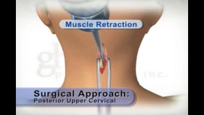 Posterior Upper Cervical | Video