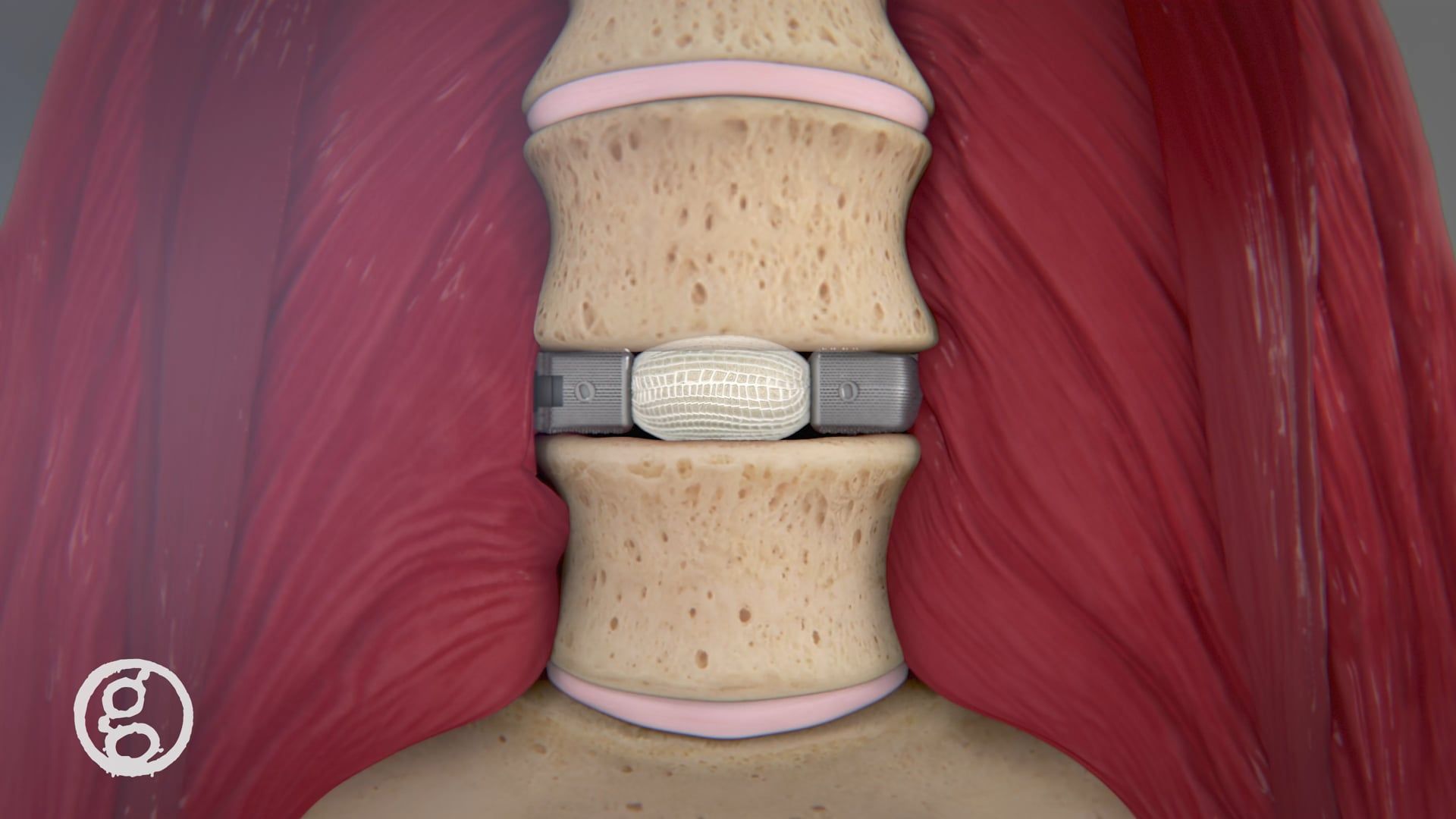 Spine Surgery with Duo™ Ti Expandable Interbody Fusion System | Video