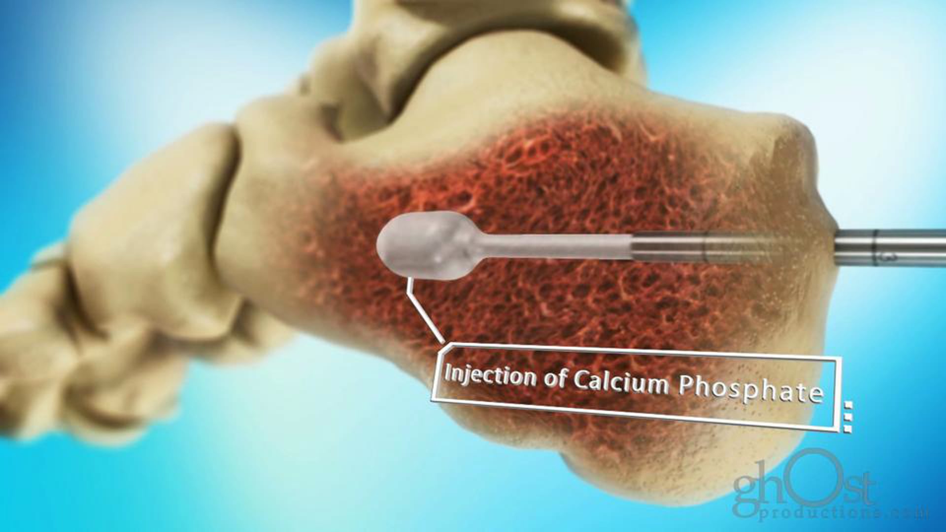 Medtronic - Inflatable Bone Tamp Marketing Reel | Video