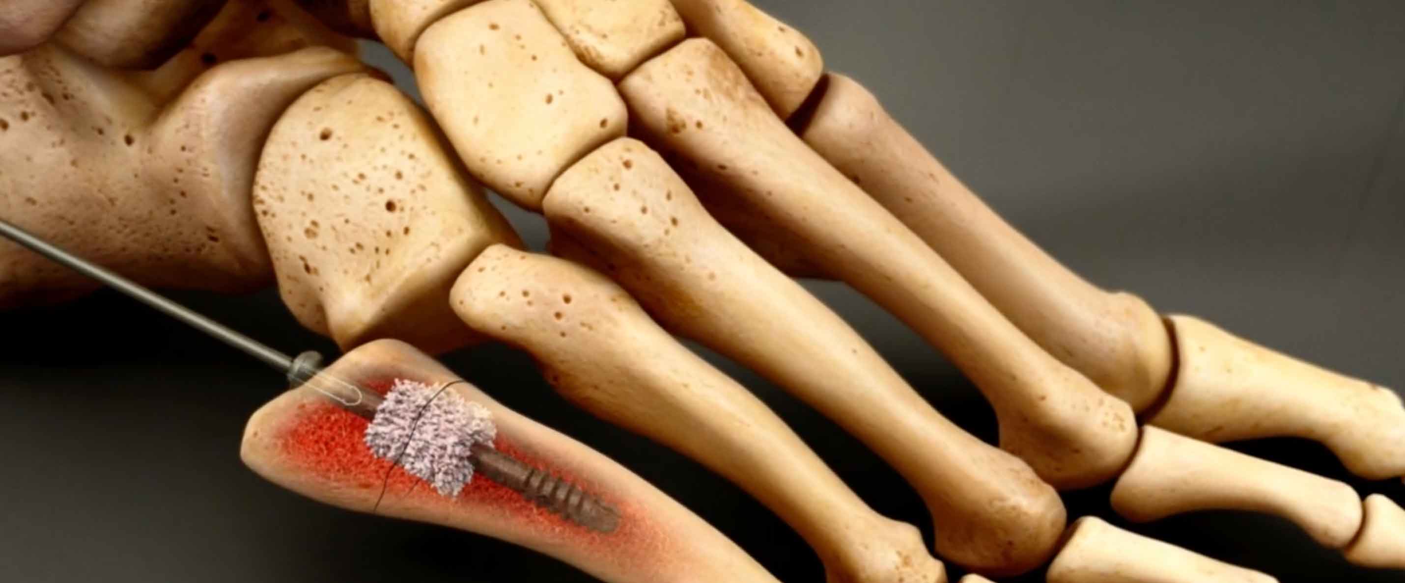 "Cannulated Screw Animation Case Study: FlowFX"