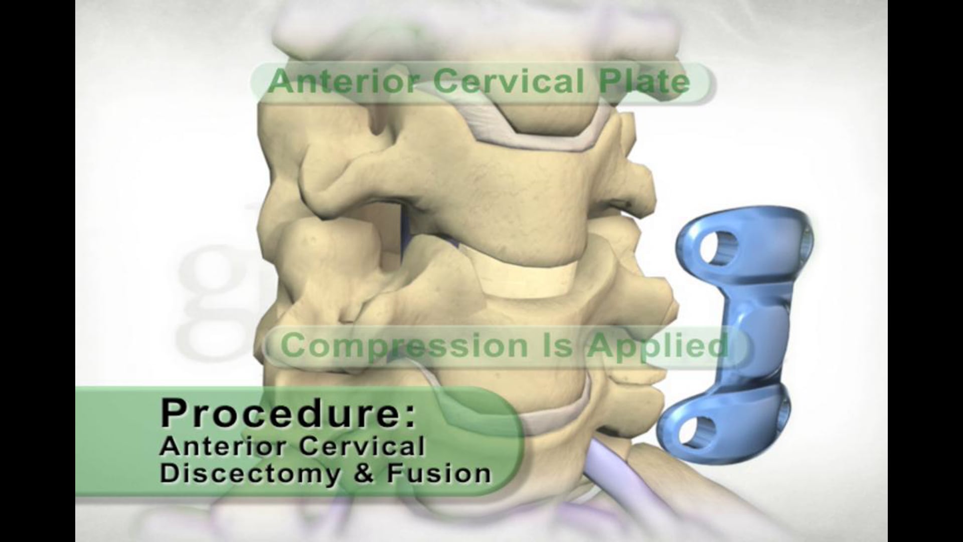 Ghost Productions - Procedure - Anterior Cervical Fusion | Video
