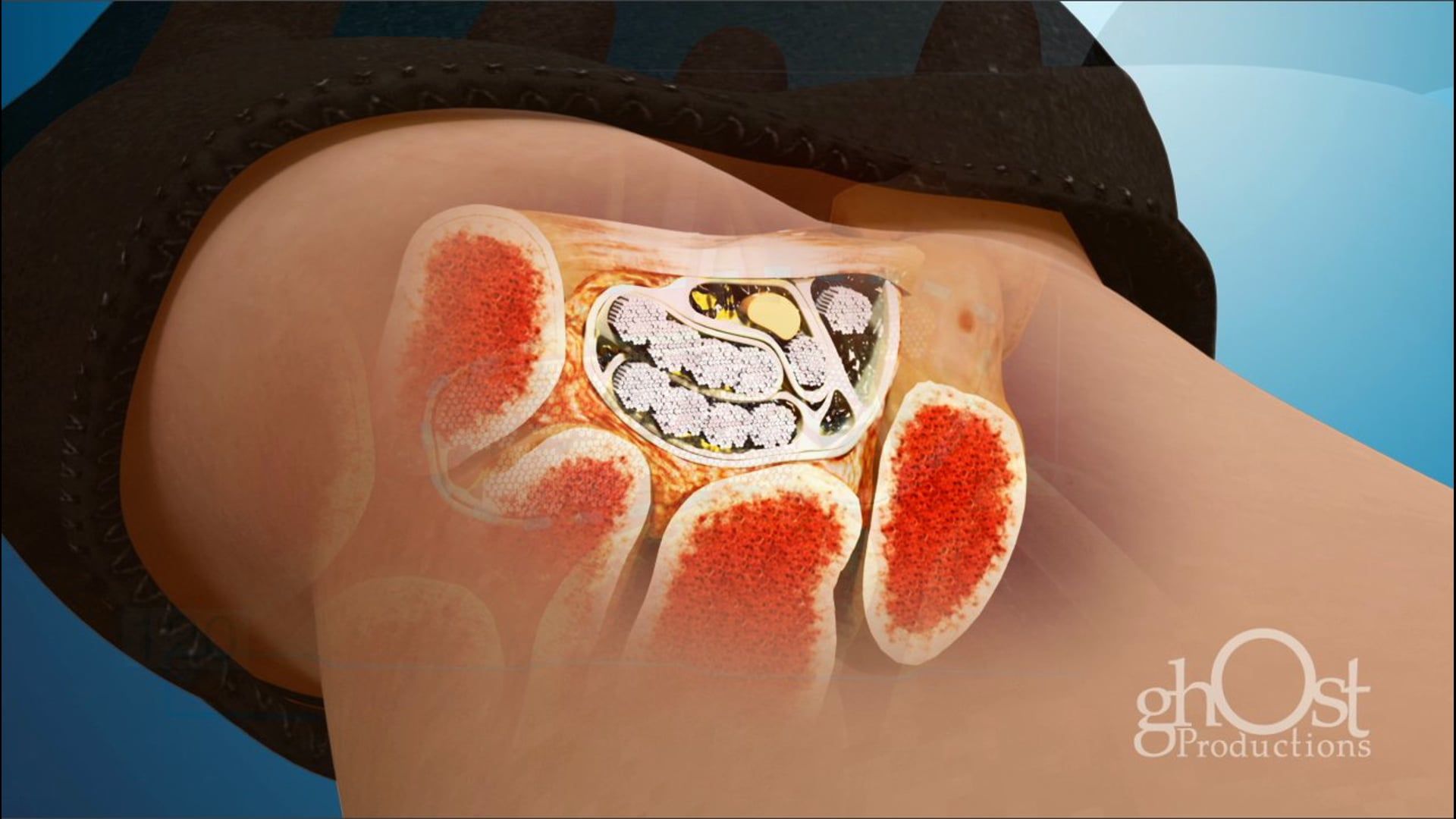 iGO Bracing | Ghost Medical Client