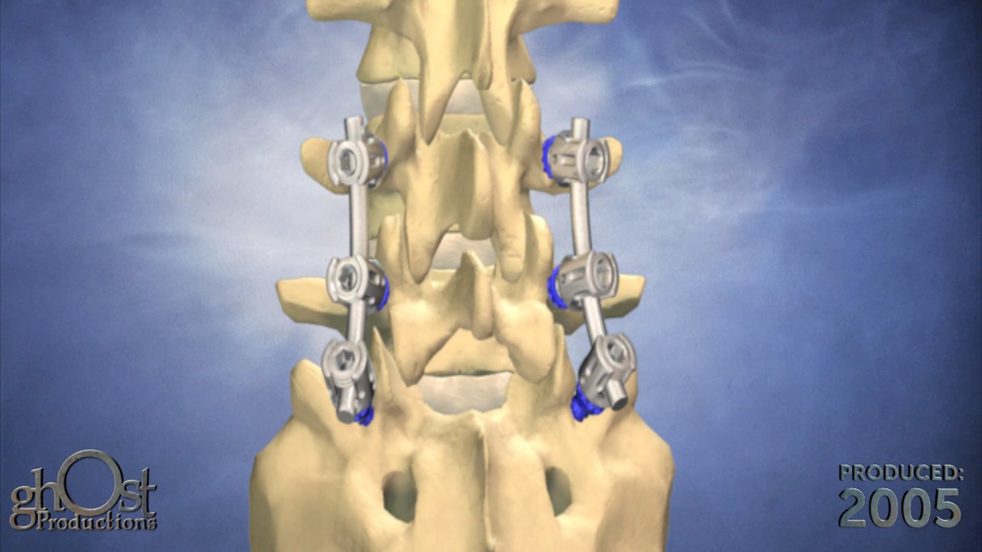 Issys Surgical Technique | Video