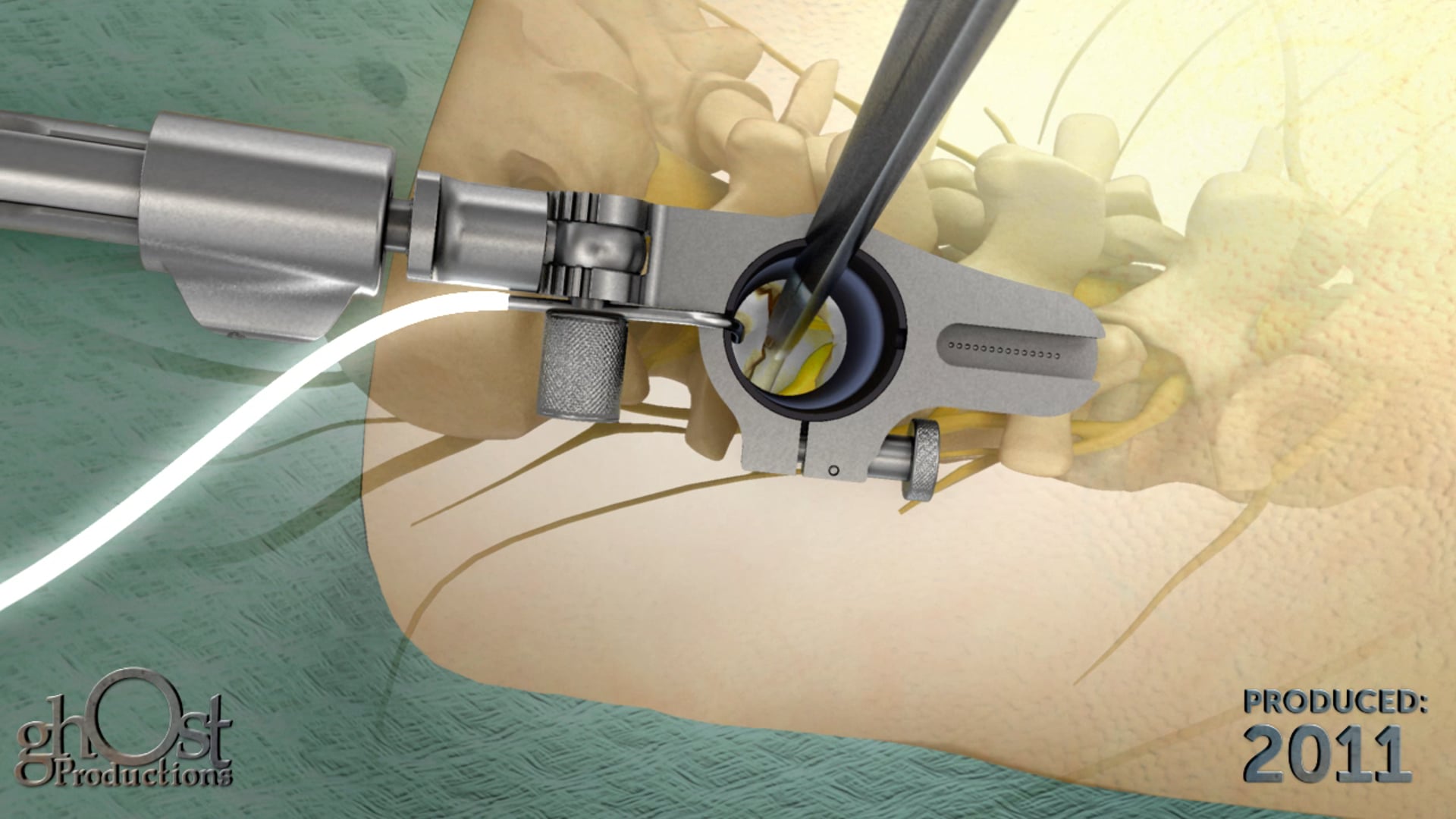 Spineology AccessPortal | Video