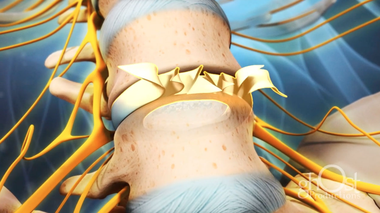 Ghost Productions - Veritas Health - Herniated Disc - HD | Video