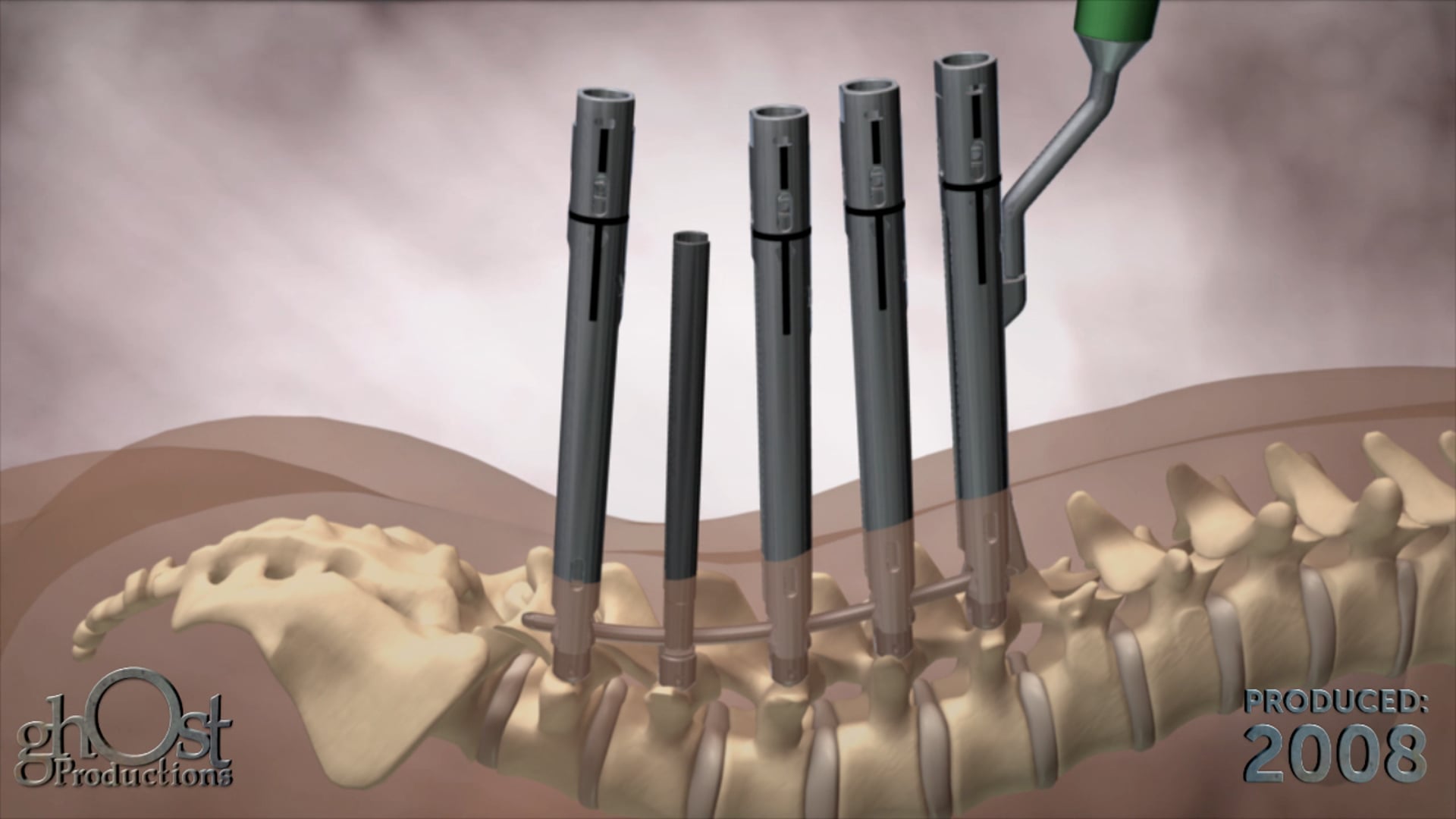 Depuy Viper2AdvancedRod | Video