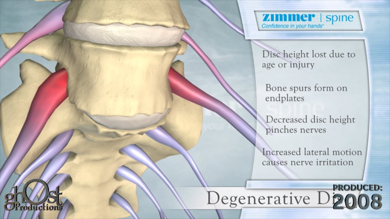 Zimmer Spine Degenerative Disc | Video