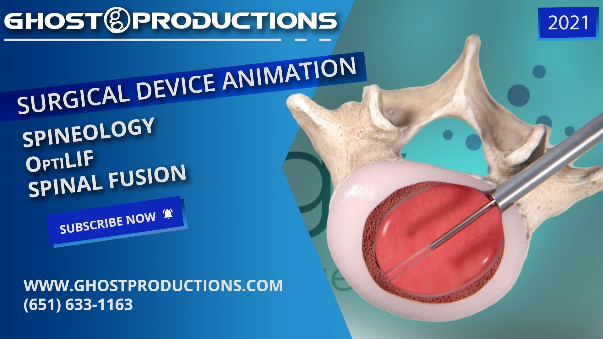 Medical Animation: Spineology OptiLIF Spinal Fusion | Video