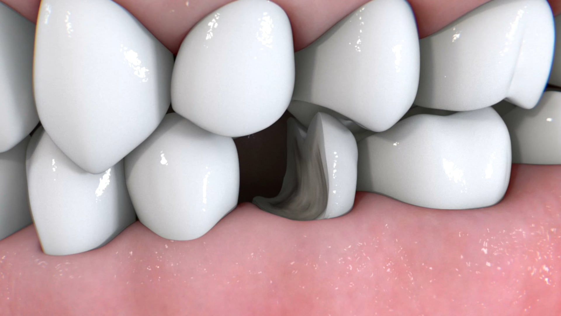 Dental Animation | Ghost Medical