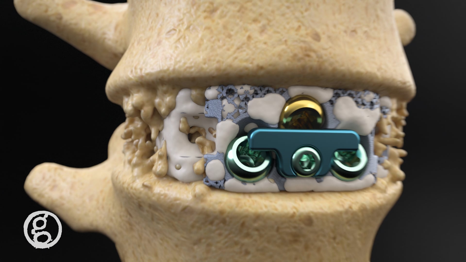 NanoHive Medical Device Marketing Animation, The Hive ALIF Cage | Video