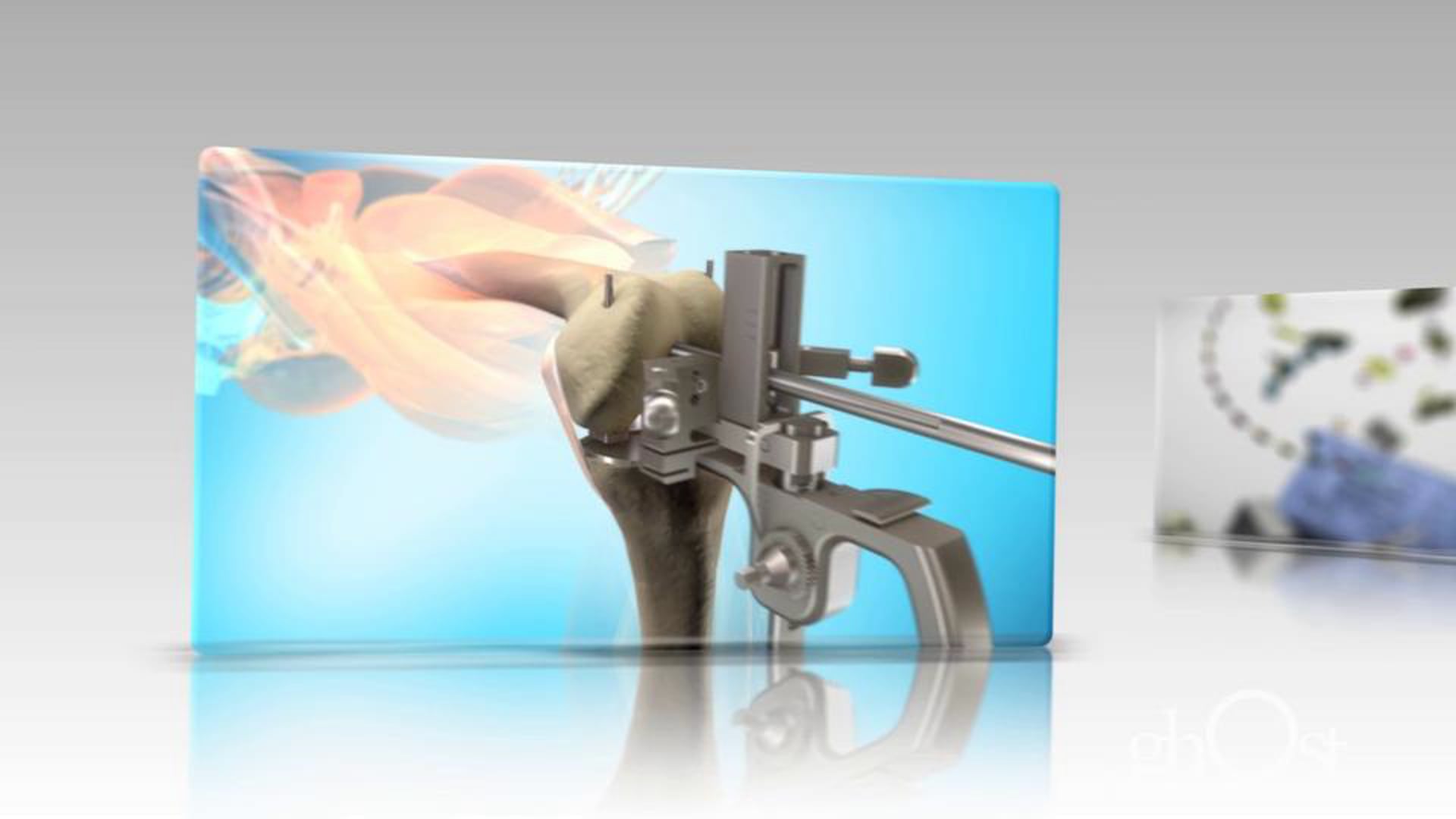 Severe Angular Injury to the Spine - Spinal Kinetics | Video