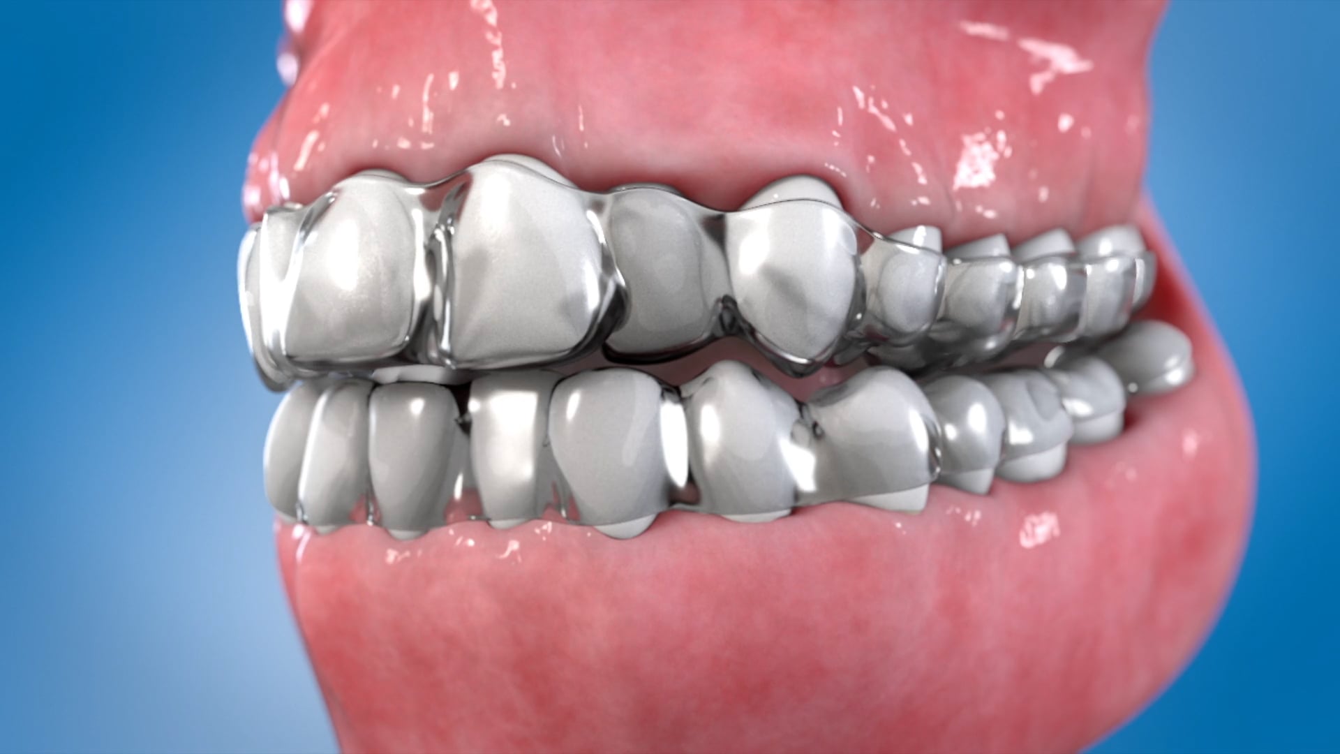 Dental Animation | Ghost Medical