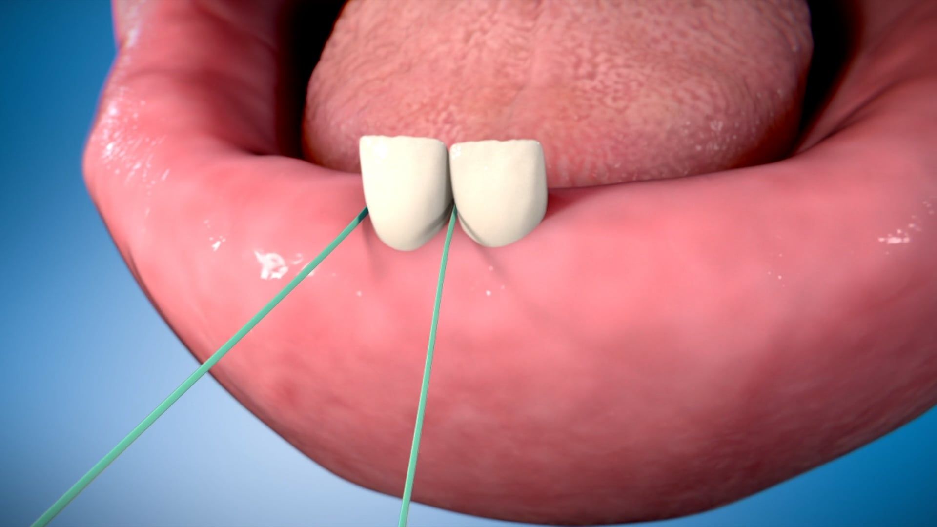 Dental Animation | Ghost Medical