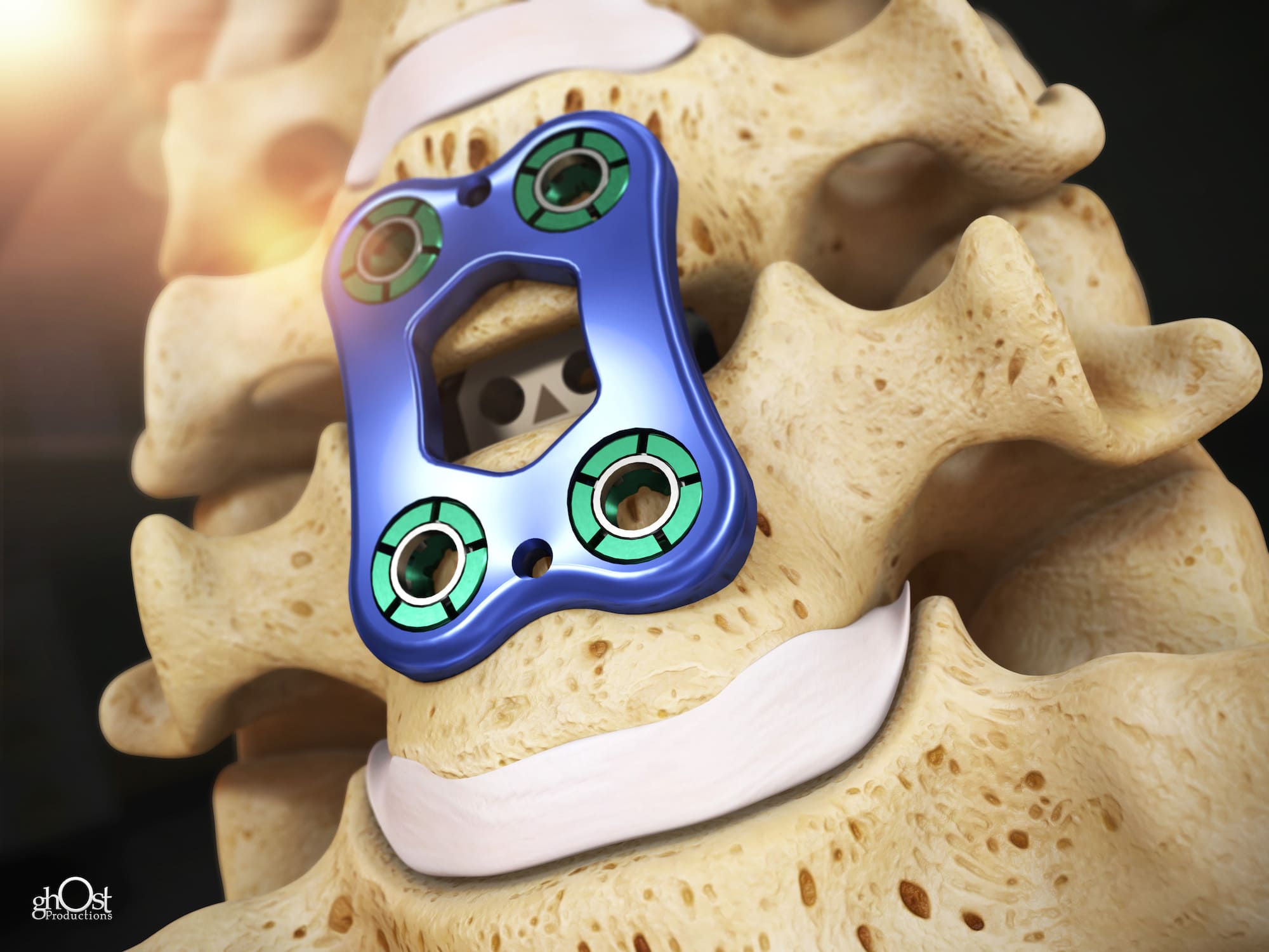 "Spinous Process Fixation Animation Case Study: Spineology VIA"