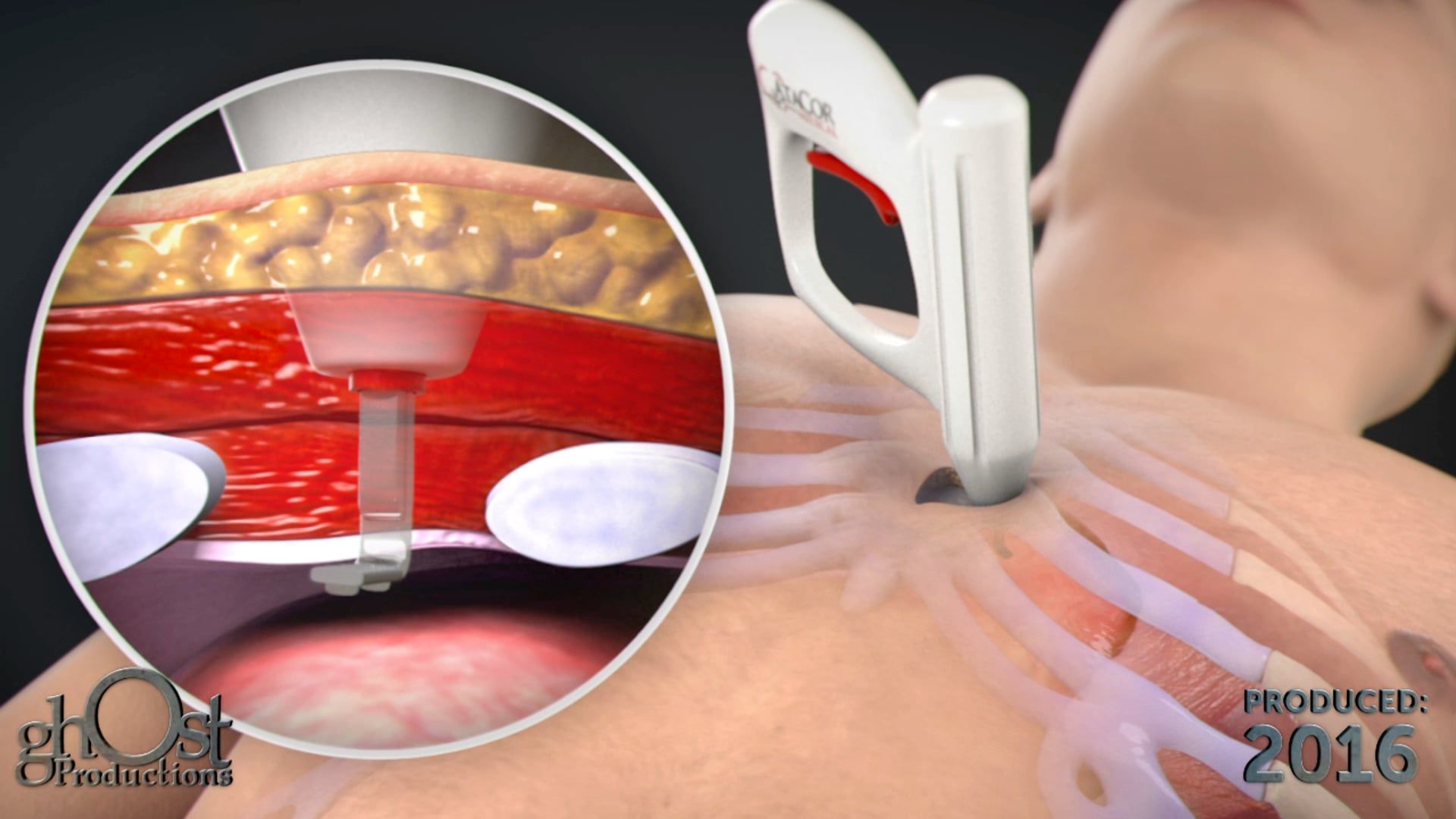 AtaCor Medical | Ghost Medical Client