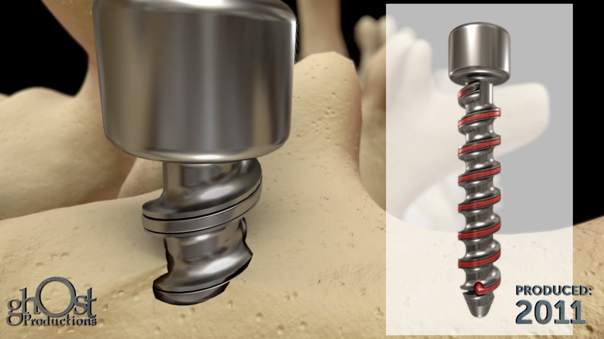 Intelligent Implant Systems Active™ Screw | Video