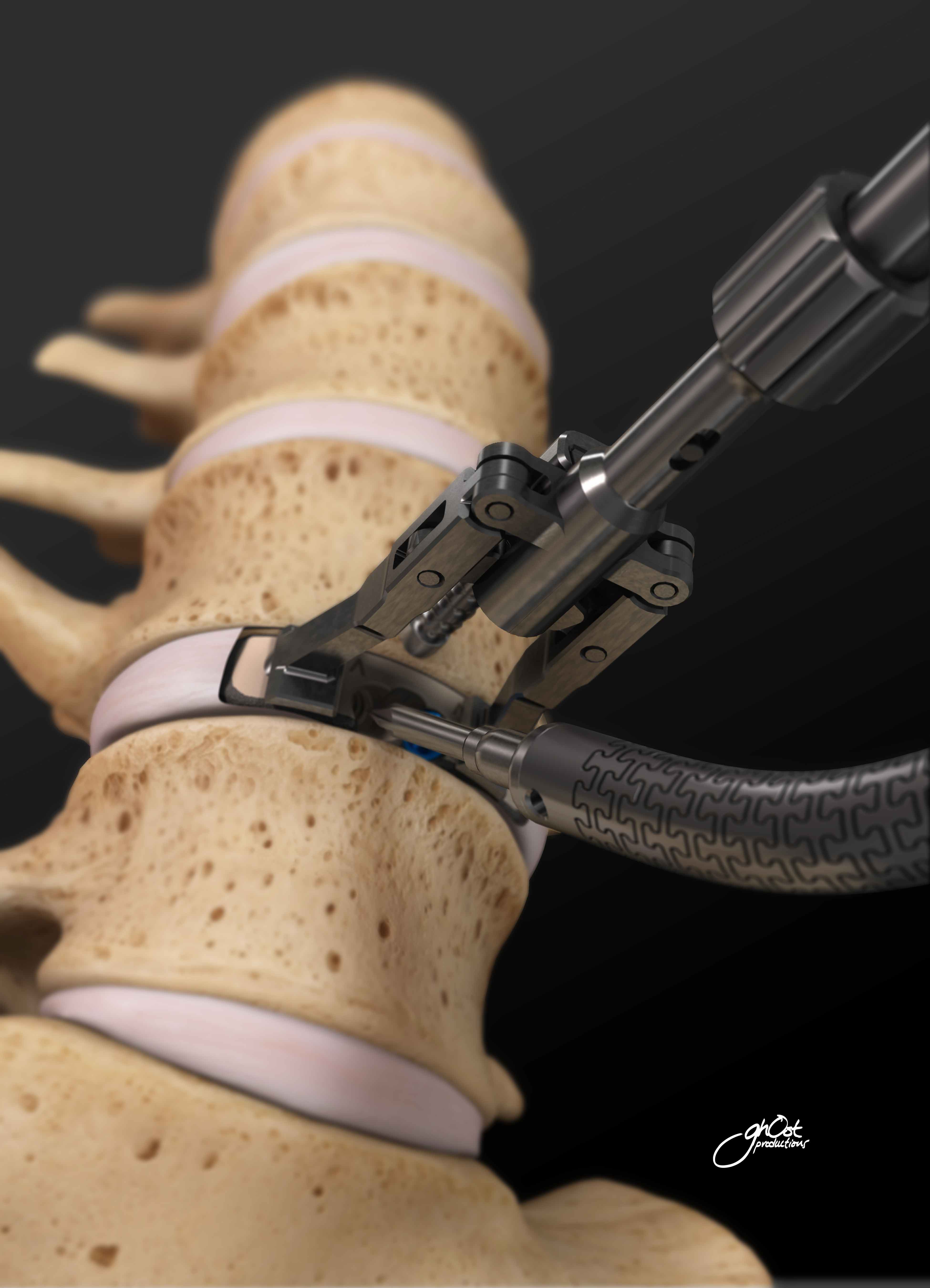 Aesculap Arcadius Interbody Device | Image