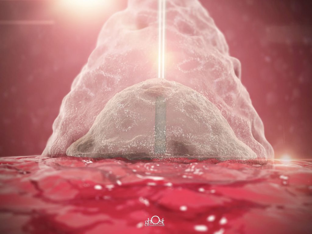 Cardinal Health’s MynxAce Vascular Closure Device | Image