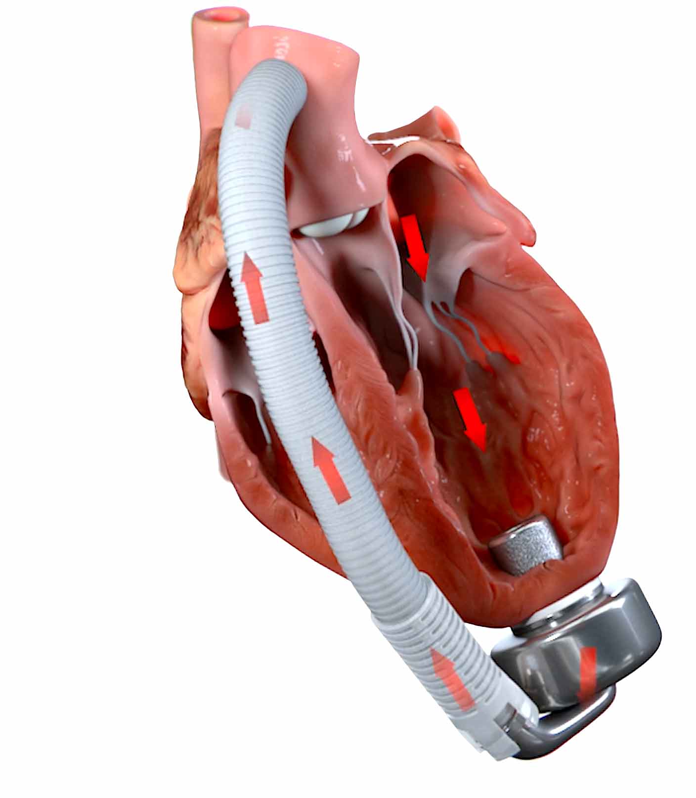 Cardiology Medical Animation | Ghost Medical