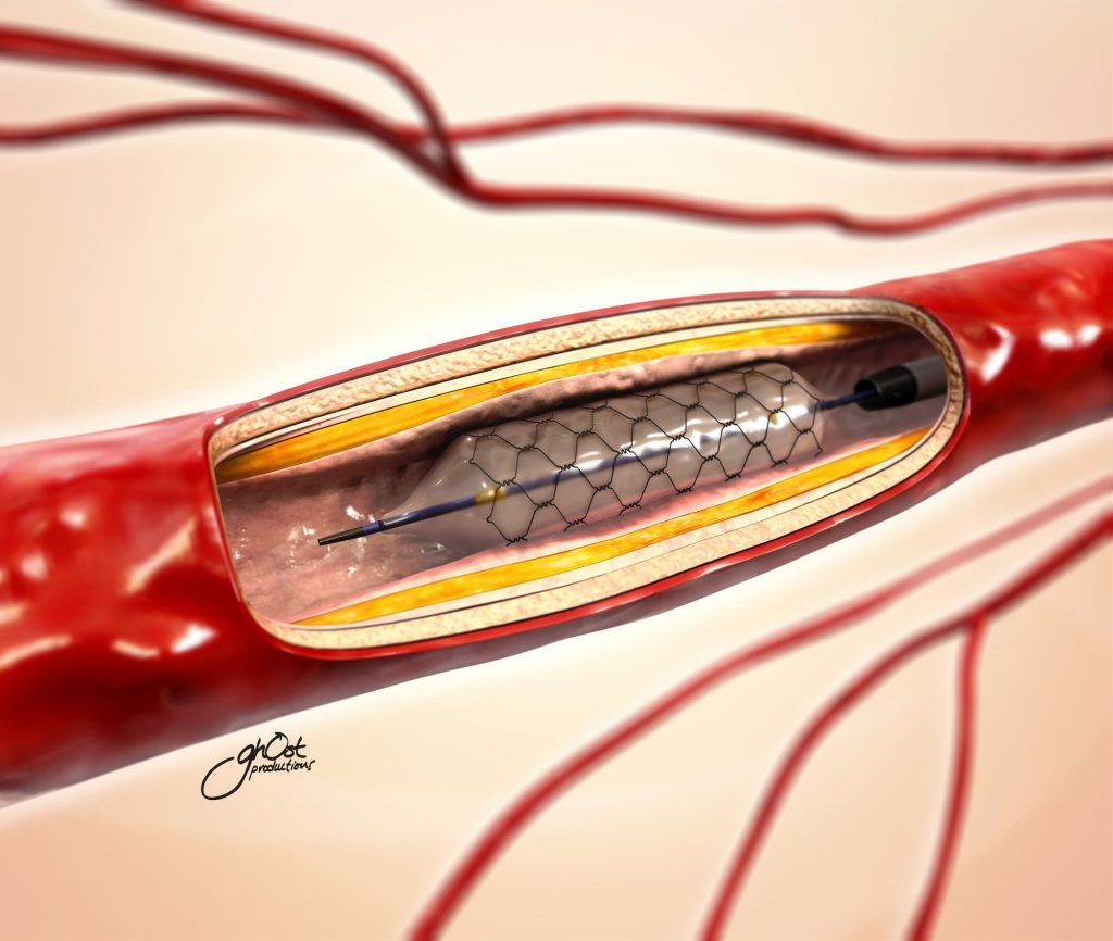 Cardiology Medical Animation | Ghost Medical
