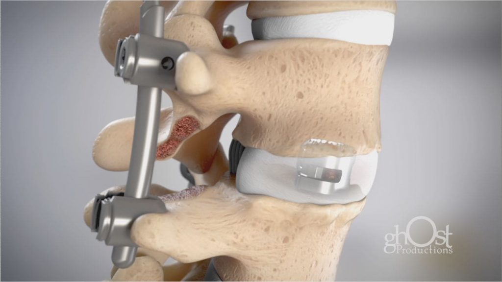 DePuy Synthes Unleash MIS TLIF System | Image