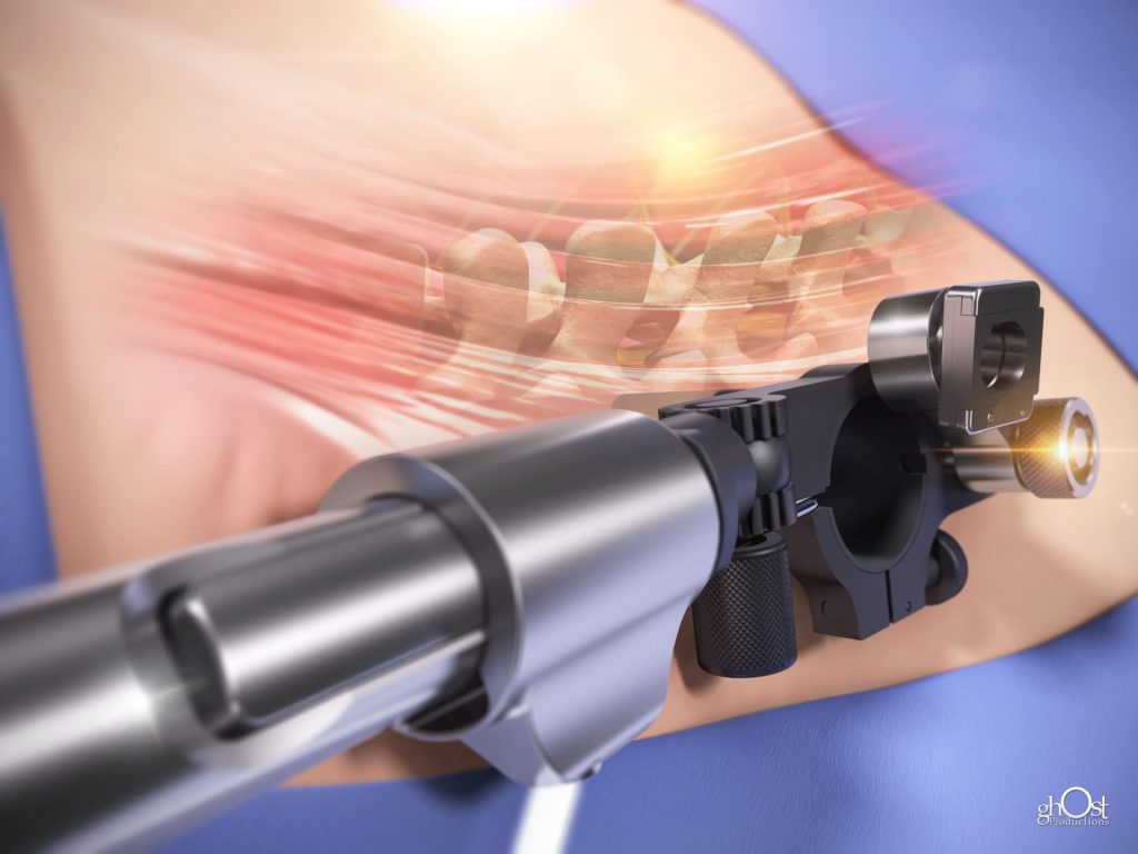 Spineology OADS Surgical Procedure | Image