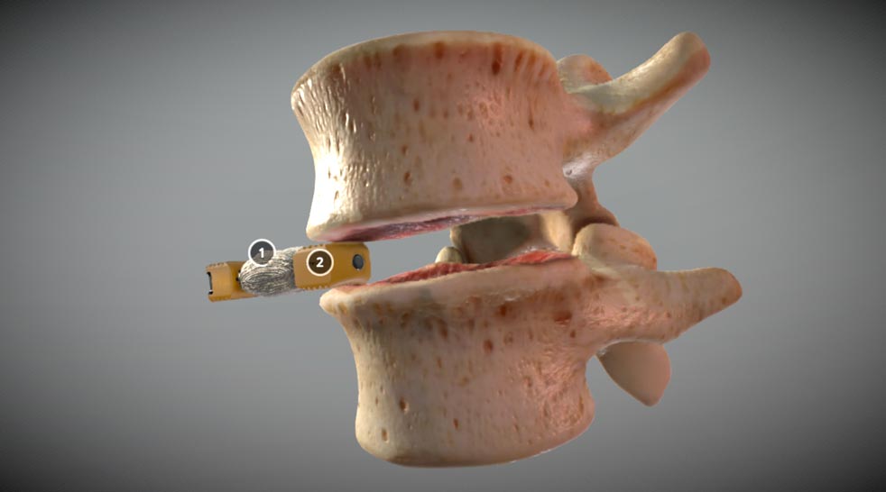 Duo™ Lumbar Interbody Fusion System | Ghost Medical