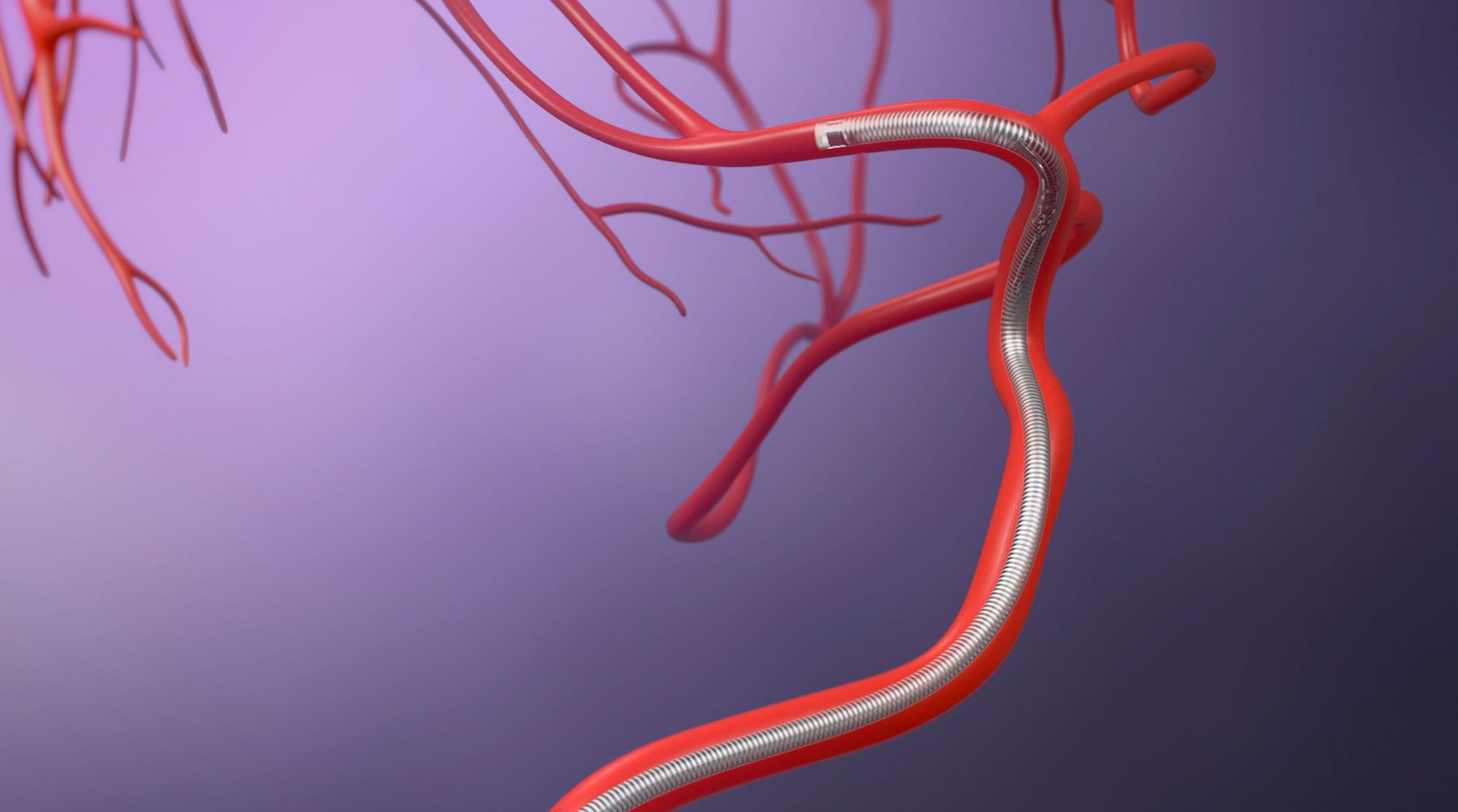 The AXS Vecta for Clot Removal - Stryker | Image