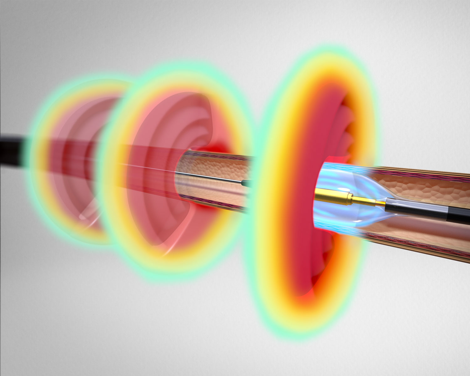 Paradise Renal Denervation System - Recor Medical | Image