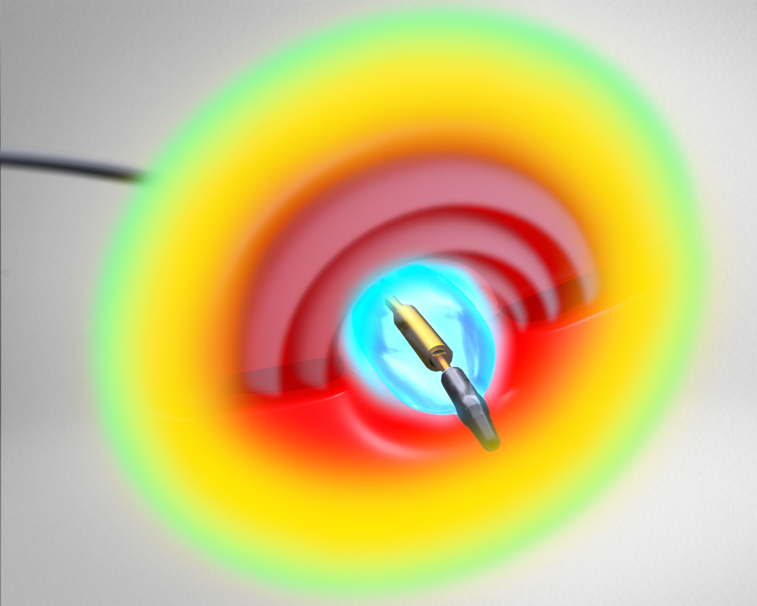 Paradise Renal Denervation System - Recor Medical | Image