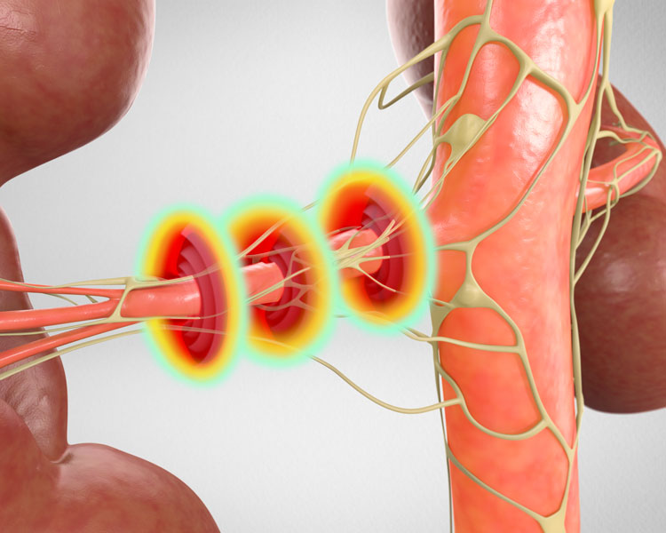 Paradise Renal Denervation System - Recor Medical | Image
