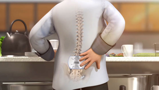 activL Artificial Disc - Relief from Degenerative Disc Disease | Image