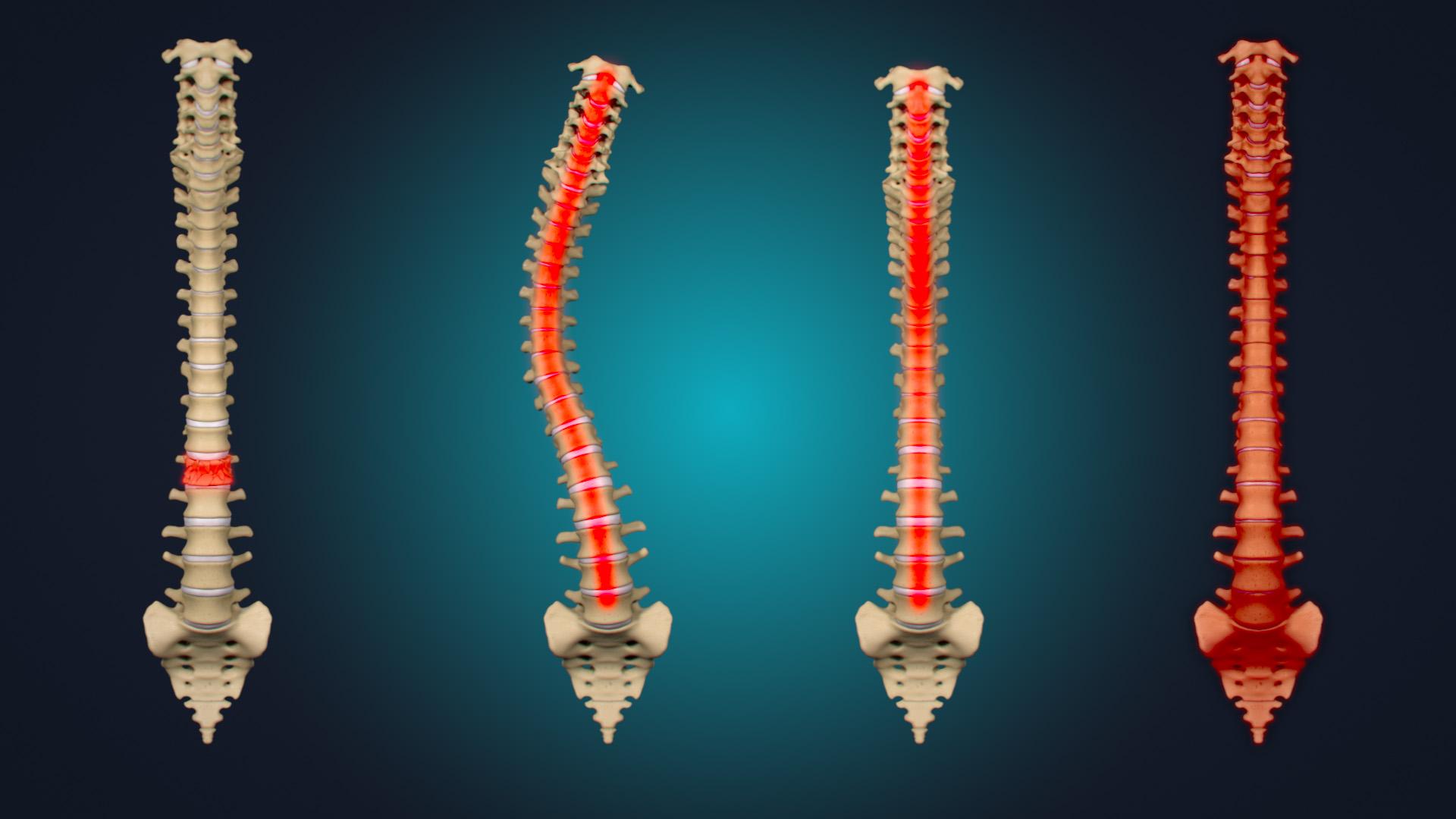 Spinal Deformities & Injuries | Image