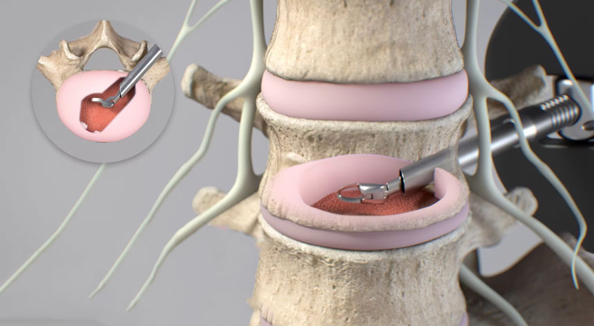 OptiLIF® Endo System Surgical Animation - Spineology | Video