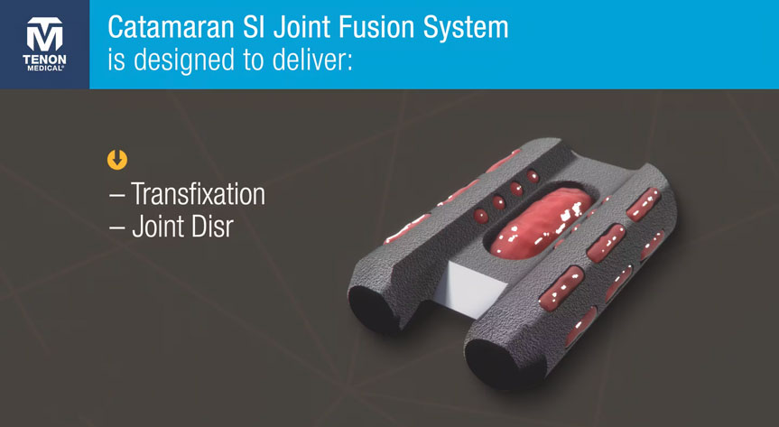 Catamaran SI Joint Fusion Device Overview - Tenon Medical | Video